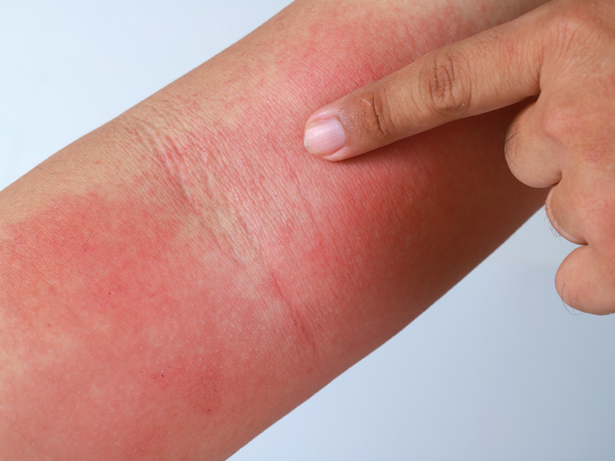 Severe Xerosis: Treatment with CleaDerma DCB - DCB CleaDerma ointment